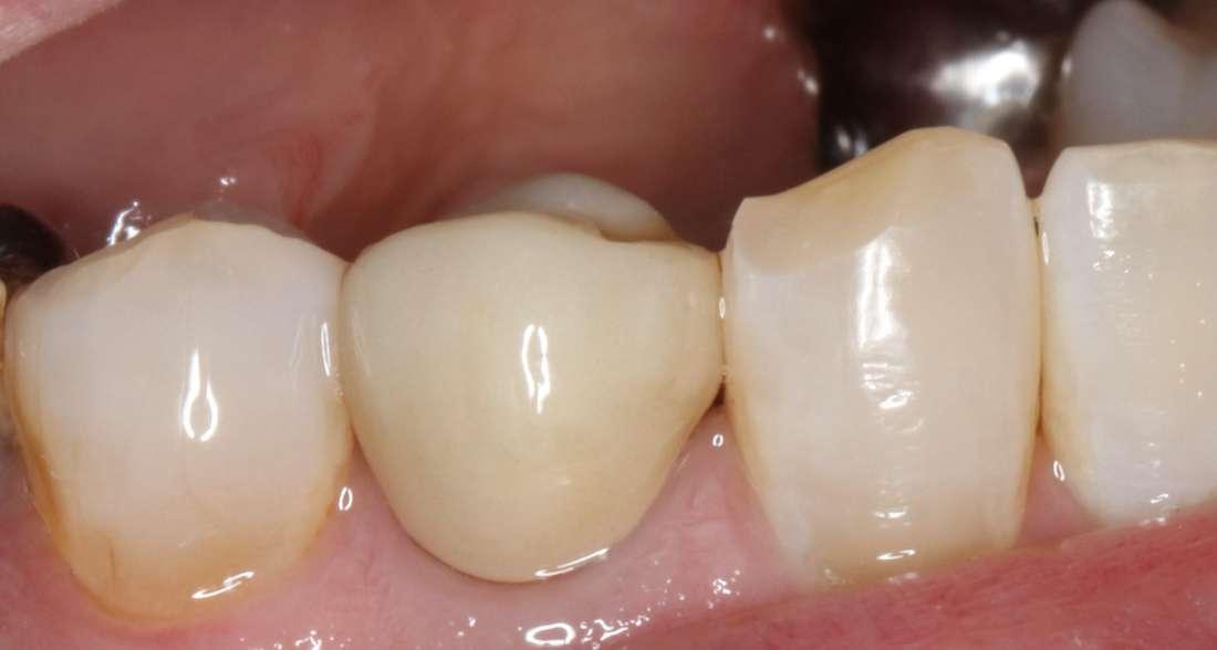 Posterior Crown and Bridge Before & After Photos | Tarzana CA